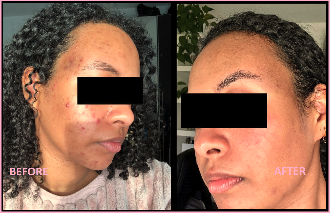 Complete Dr. V TRIO Blemish Range | Oily Skin & Acne Prone Skin ...