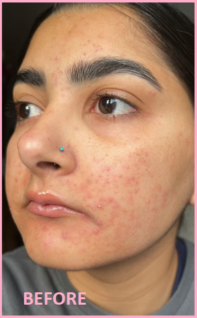 Complete Dr. V TRIO Blemish Range | Oily Skin & Acne Prone Skin ...