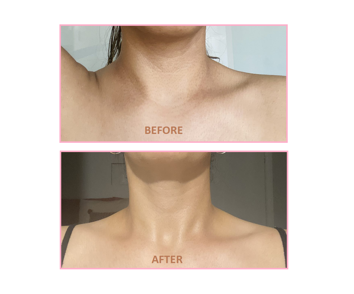 Dr. V Body Pigmentation Kit | Hyperpigmentation (dark marks) reduction ...