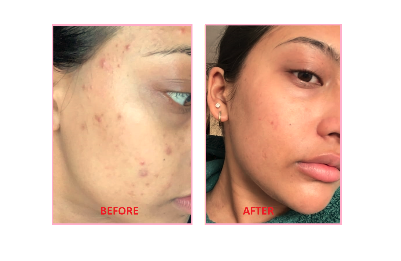 Dr Vanita Rattan TRIO Blemish PM Gel Moisturiser | Oily Acne Skin ...