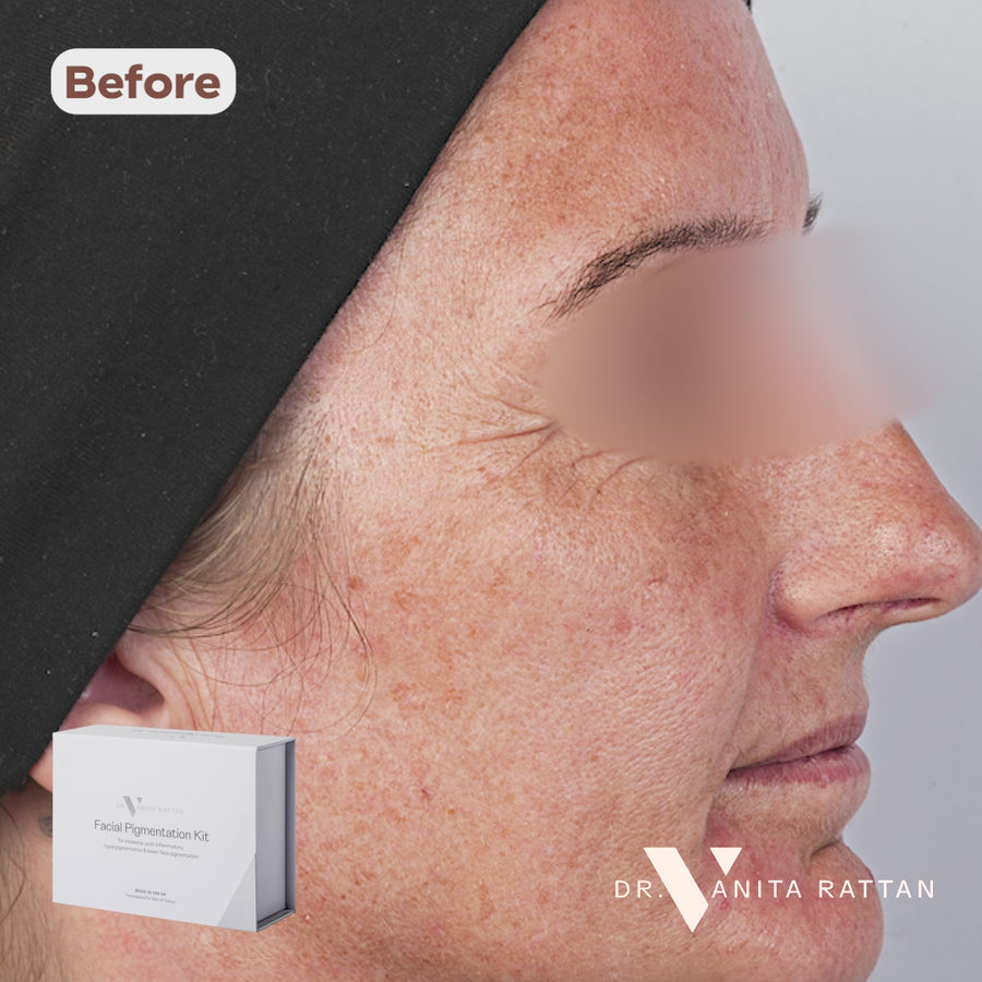 Dr V Facial Pigmentation Kit - Hyperpigmentation Treatment | Brown ...