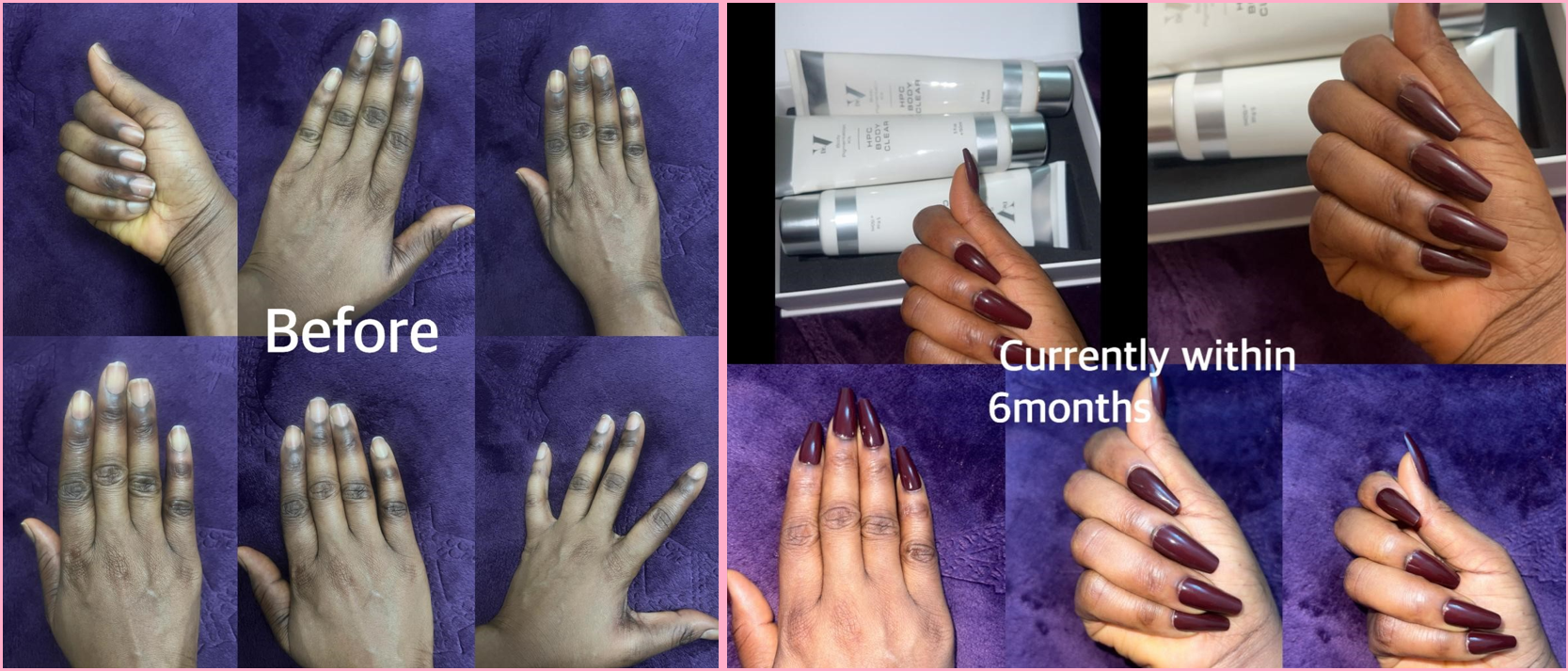 Dr. V Body Pigmentation Kit | Hyperpigmentation (dark marks) reduction ...